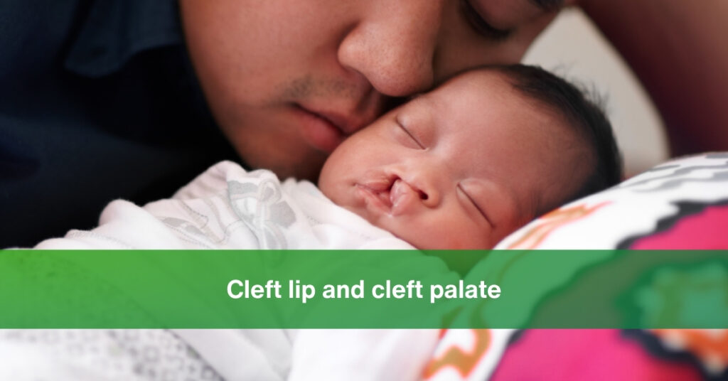 Cleft Lip and Palate Awareness: Causes, Symptoms and Risk Factors 2024