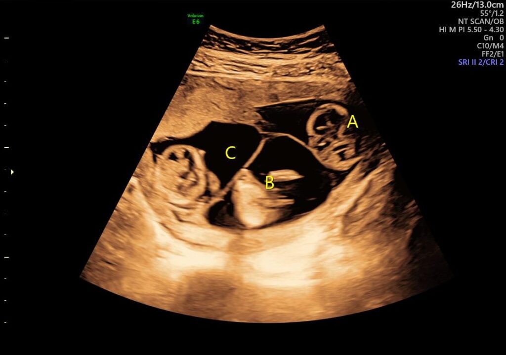 Multiple Pregnancy Scan: Twins and Triplets Scan in Chennai