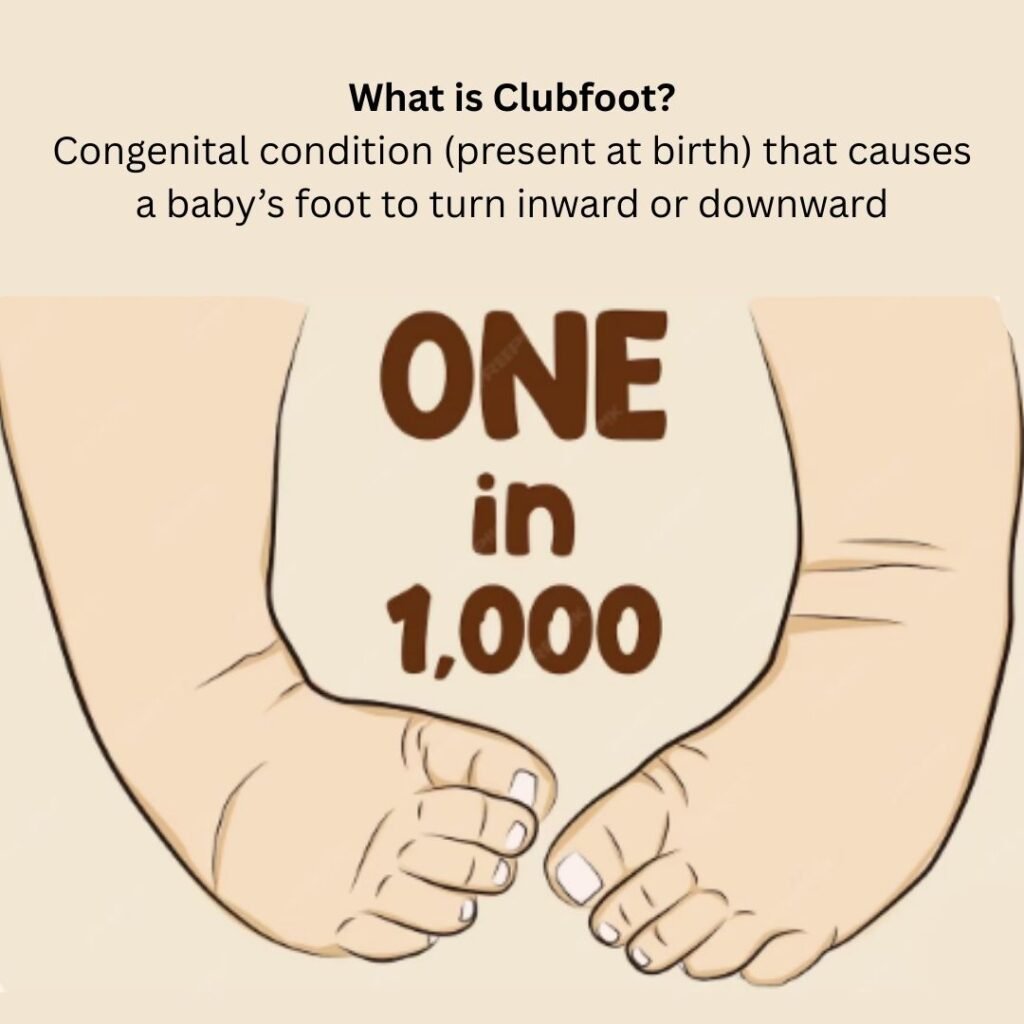 Clubfoot in Pregnancy (Talipes): An Inspiring Case Study