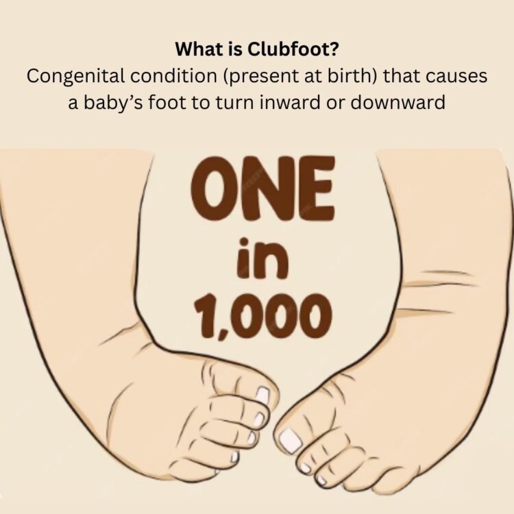 Clubfoot in Pregnancy (Talipes): An Inspiring Case Study